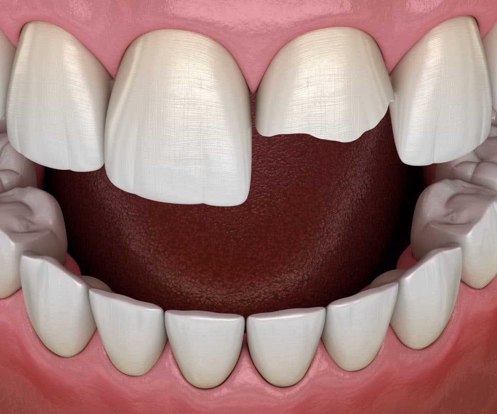 Houston Dentist Looks At How Dental Bonding Repairs A Tooth | Houston ...