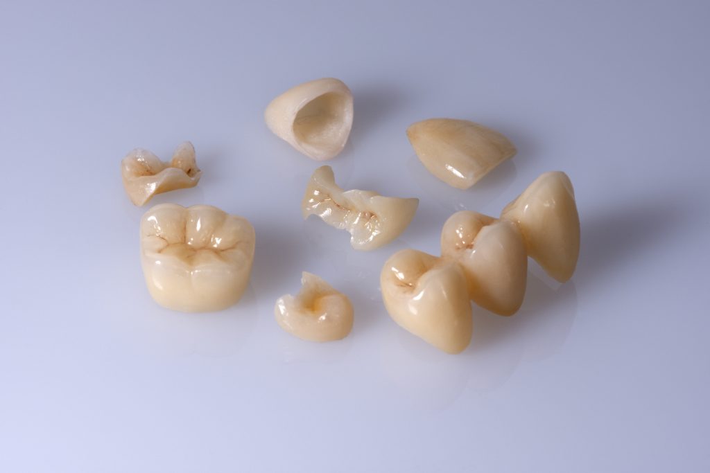 Houston Dentist Explains When Your Smile Needs A Full Or Partial Crown ...