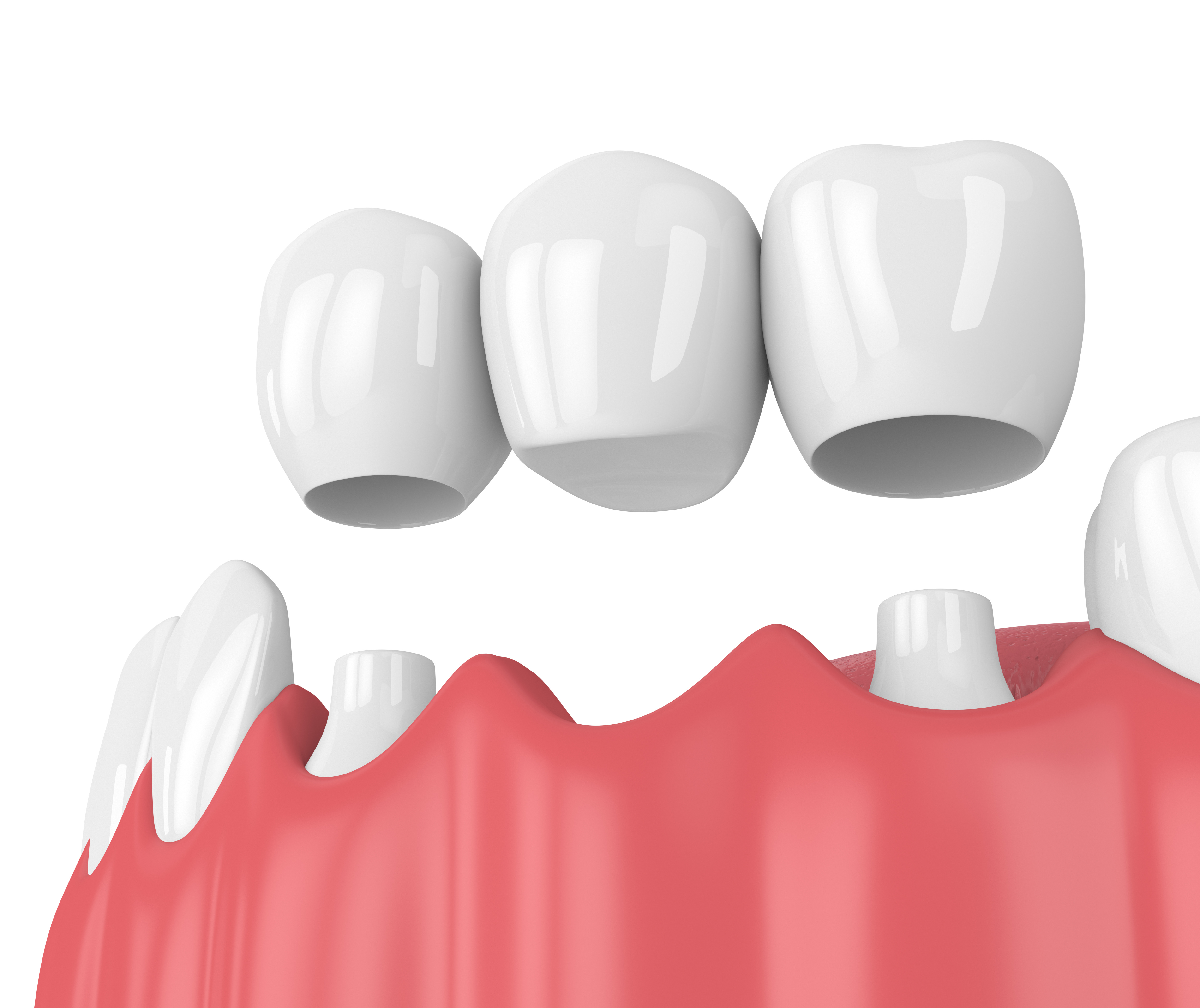 Houston Dentist Can Fill Your Smile’s Gaps With A Bridge | Houston, TX