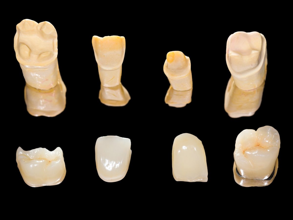 Do You Need A Full Or Partial Crown? | Houston, TX