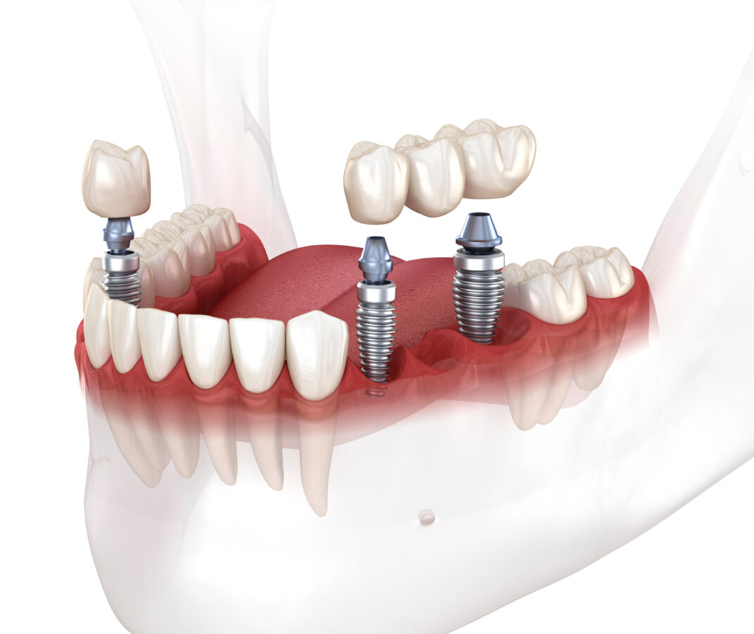 How Bridges Replace Missing Teeth | Houston, TX